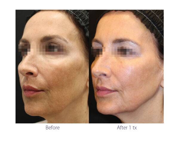 Clearlift – Highline Aesthetics